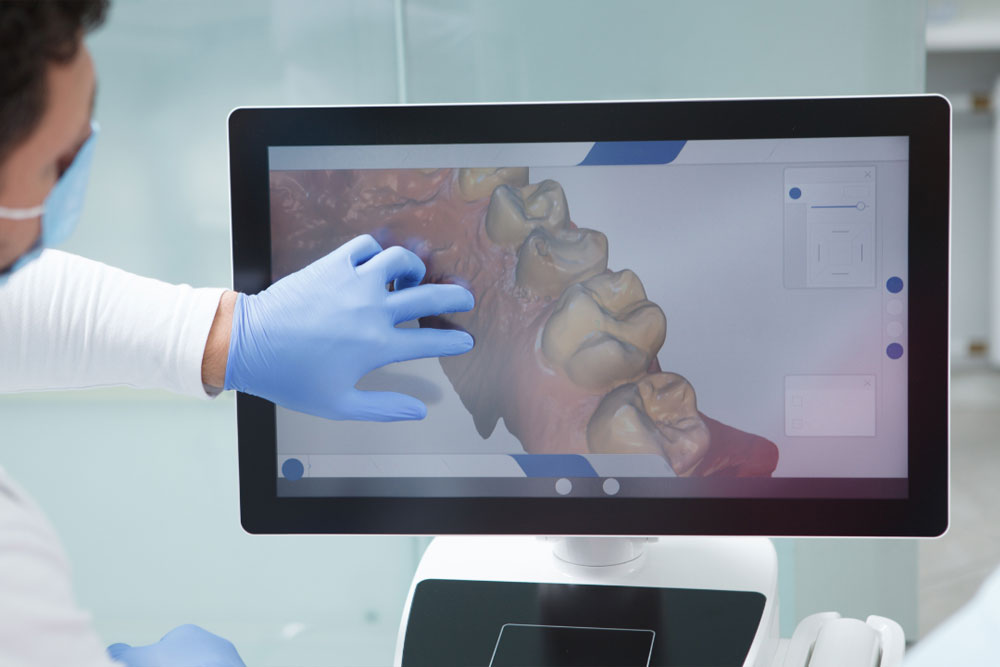 iTero Digital Scanners – iSmile Dental